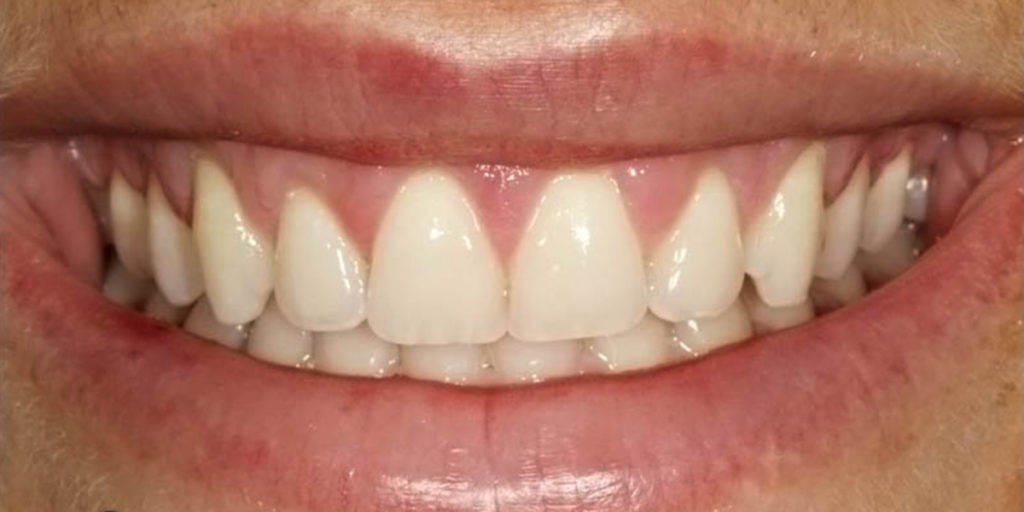 Gummy Smile Correction Photo Gallery - Center 4 Smiles