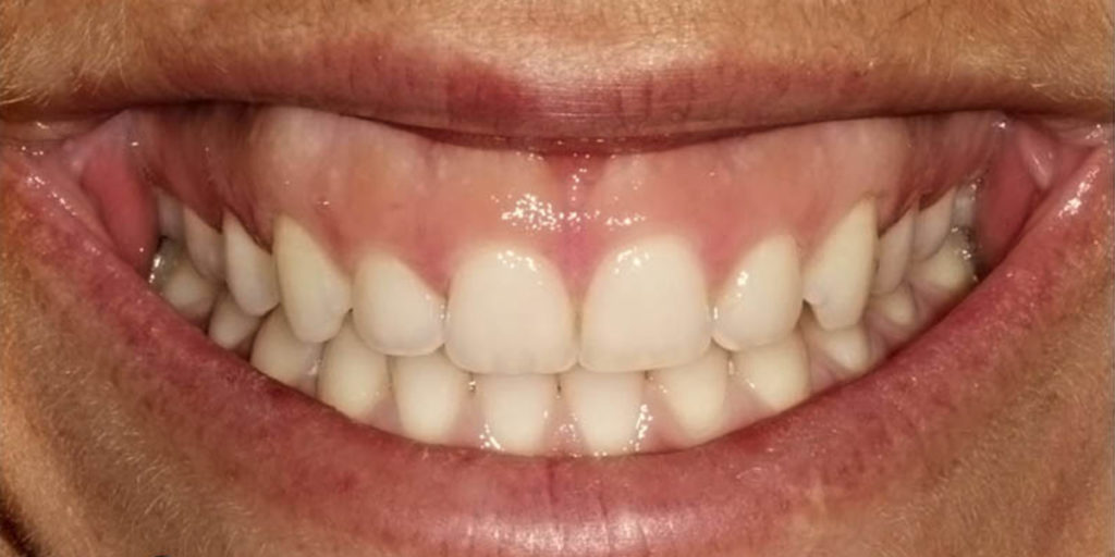 Gummy Smile Correction Photo Gallery - Center 4 Smiles