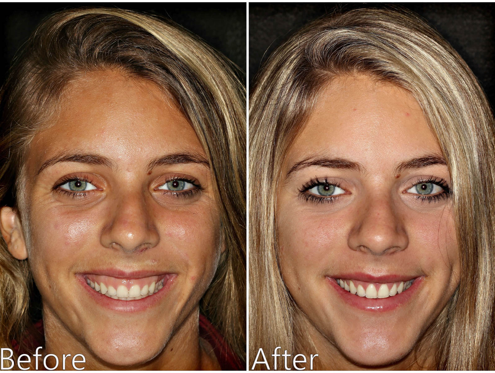 Gummy Smile Correction Photo Gallery Center 4 Smiles Gummy Smile Correction Photo Gallery Center 4 Smiles