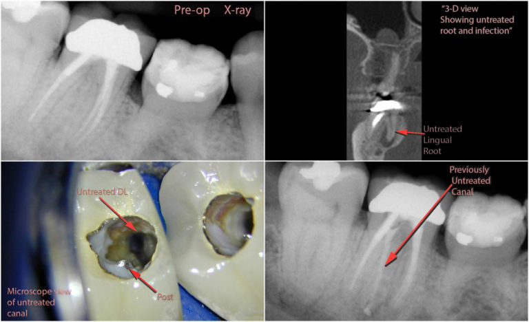 3D Image and Root Canal Procedure - Center 4 Smiles