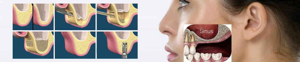 Sinus Grafting Procedure Performed by the Specialists at Center 4 Smiles
